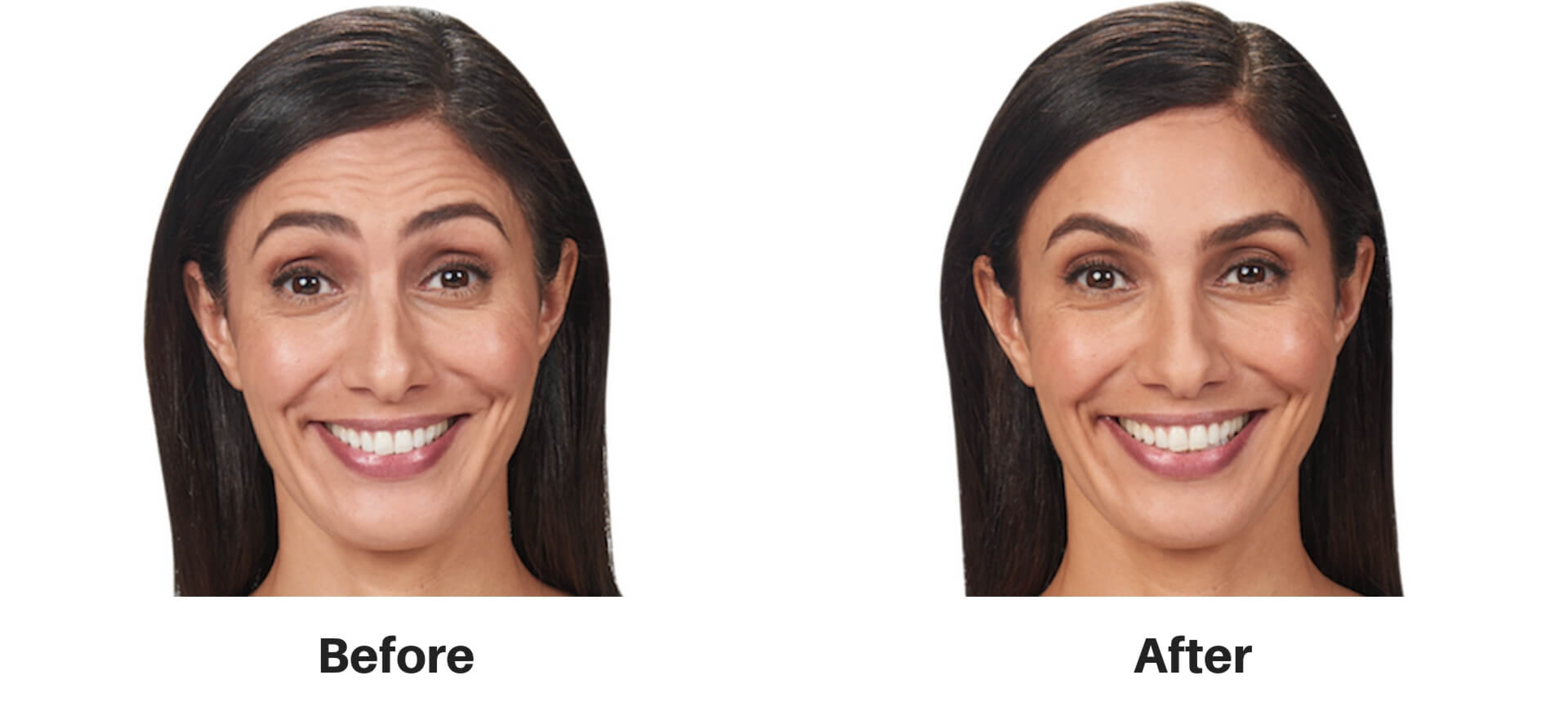 BOTOX | XEOMIN | DYSPORT | JEUVEAU by Slate Medspa