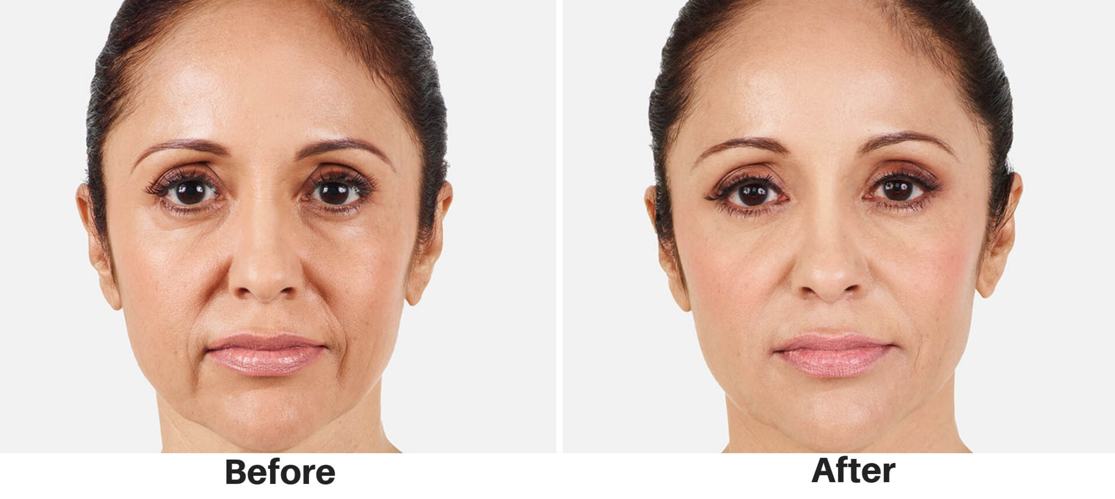 Facial Fillers New Jersey, NJ | Slate Medspa